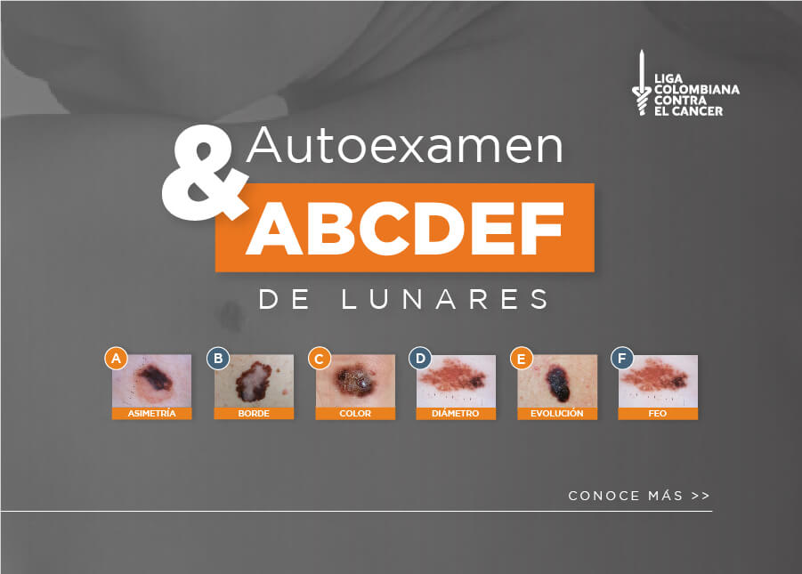 Autoexamen y ABCDEF de lunares - Liga Colombiana contra el Cáncer